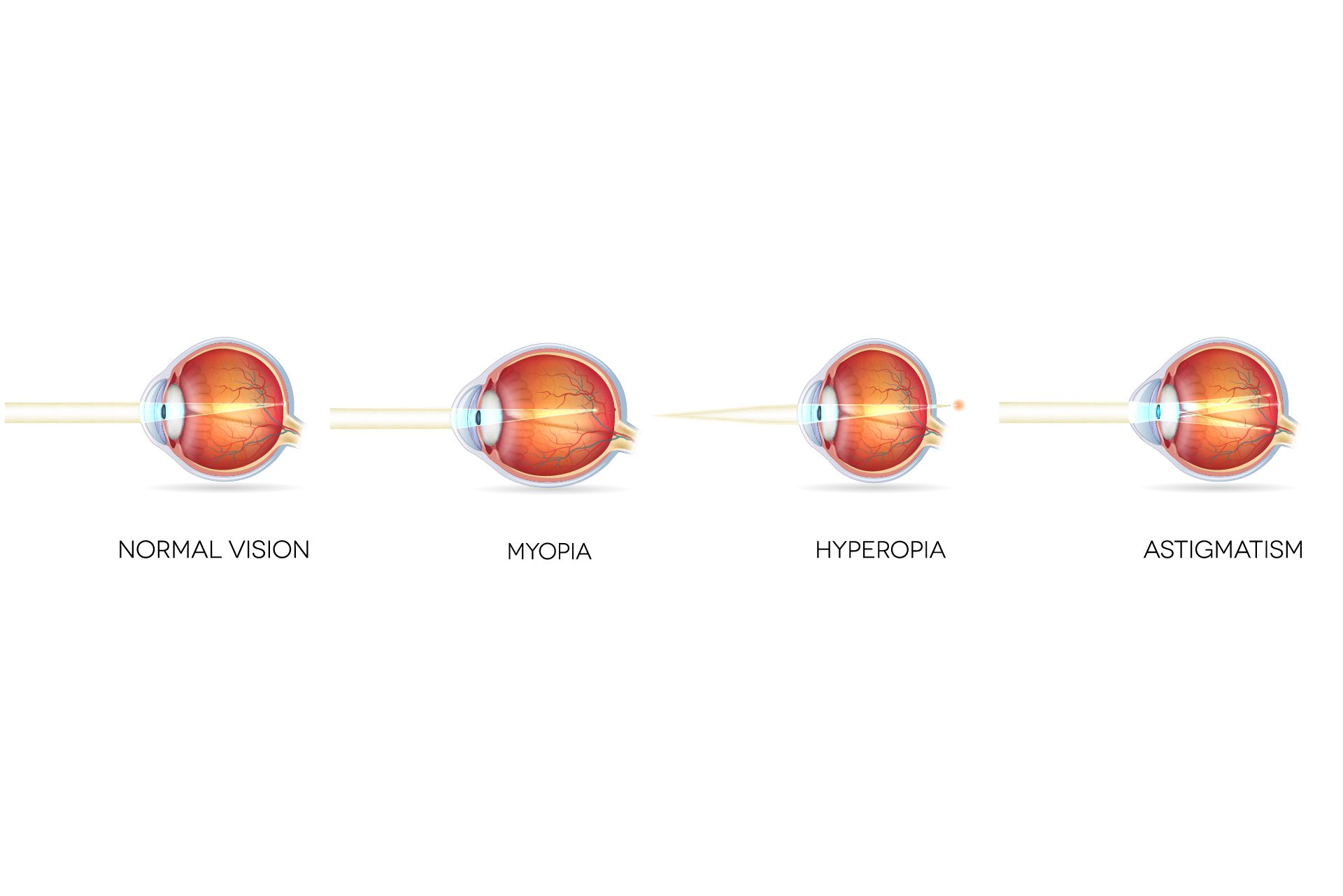 Refractive Abnormalities - Dr. Γιούλα Μπάρλα FEBO Οφθαλμίατρος Χειρουργός